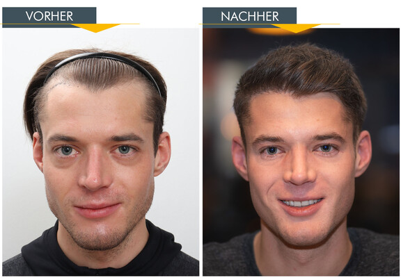 Haartransplantation Philipp Aschenwald | Moser Medical